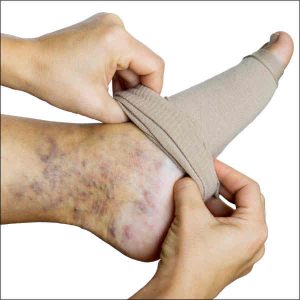 Langzeitanwendung von Kompressionsstrümpfen nach Thrombose - Schöne Beine